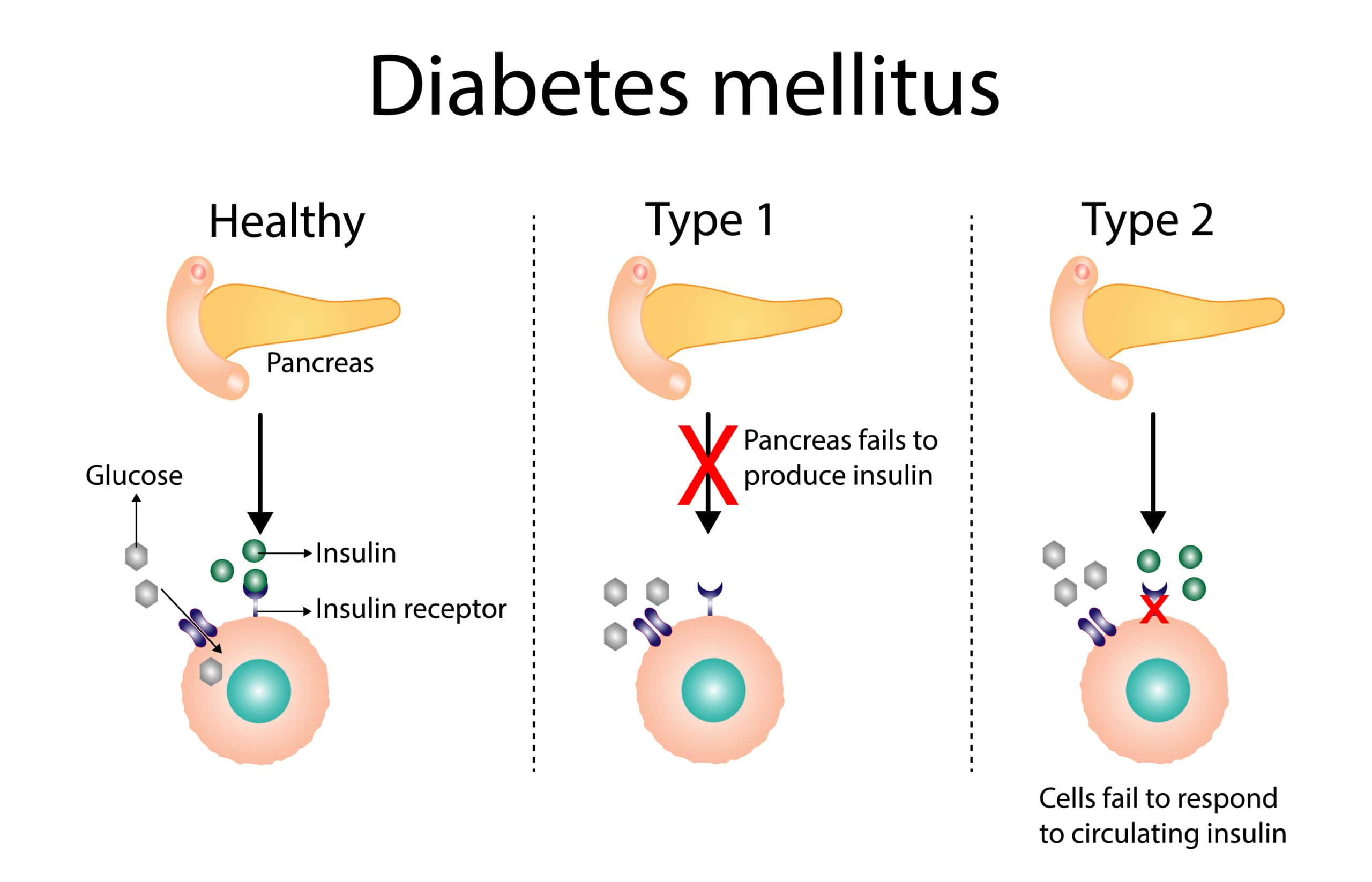 Type 1 And Type 2 Diabetes Mellitus: Causes, Symptoms, Diagnosis, And ...